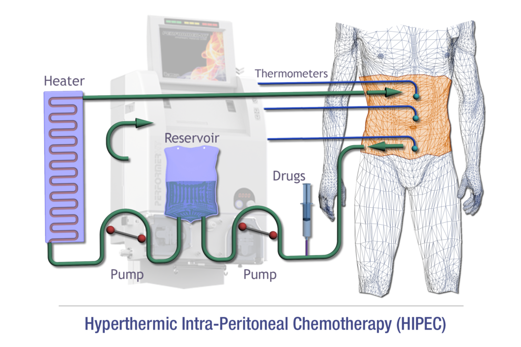 Peritoneal Cancer - North Houston Cancer Clinics