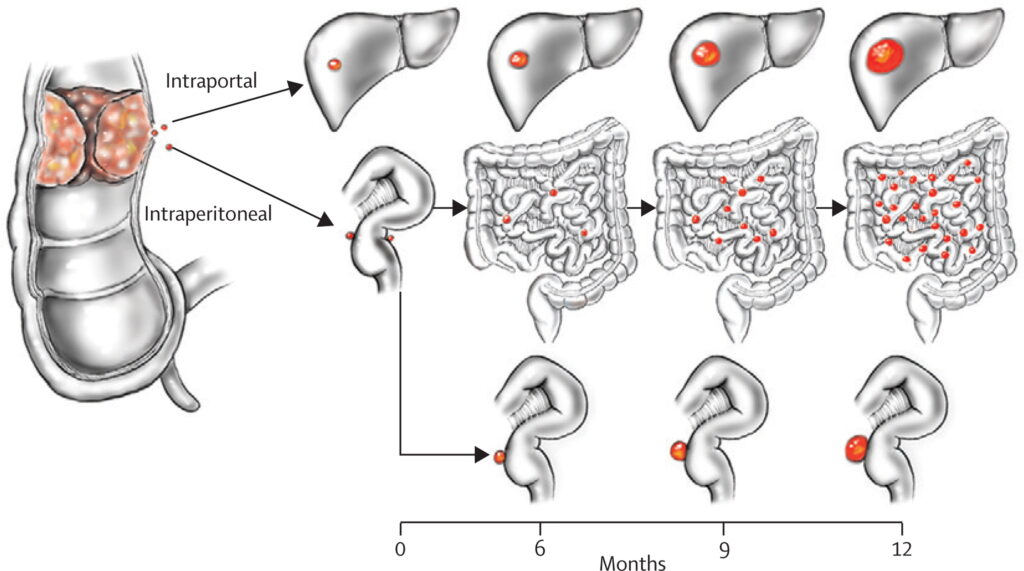 Peritoneal Cancer - North Houston Cancer Clinics